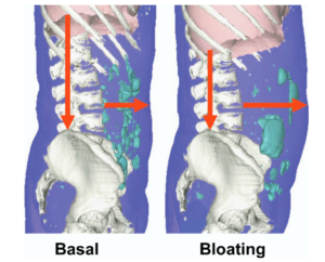 Bloating and Distension: What’s the Difference? - Rome Foundation